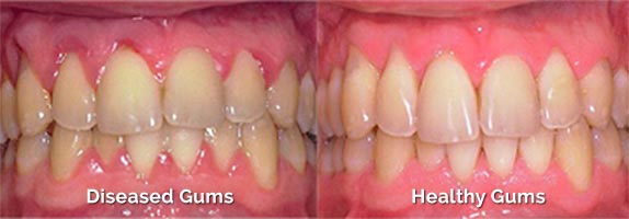 Periodontitis Treatment Before And After